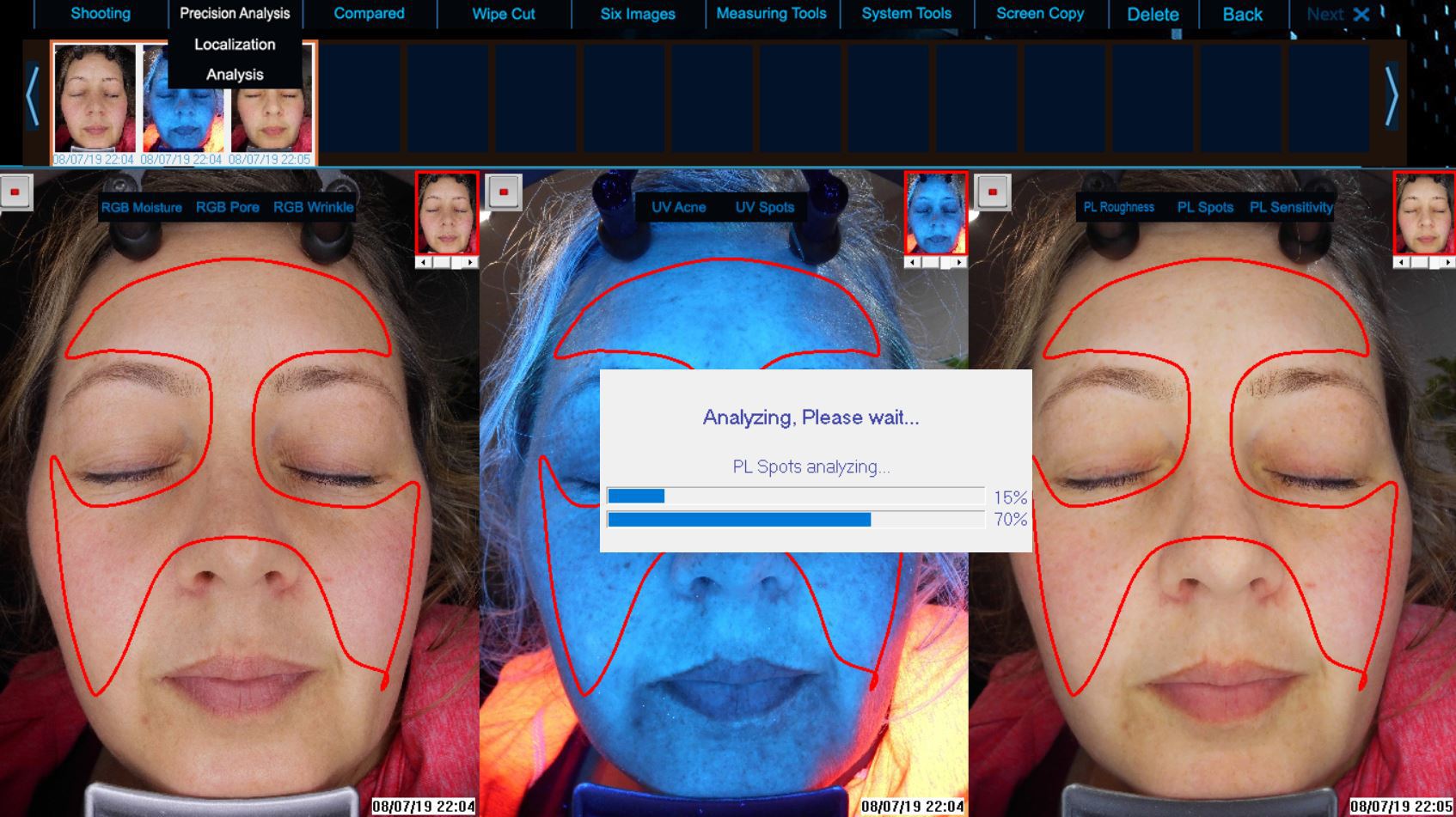 DermaPro6S Complete Set up package with Monitor - Youth Beauty